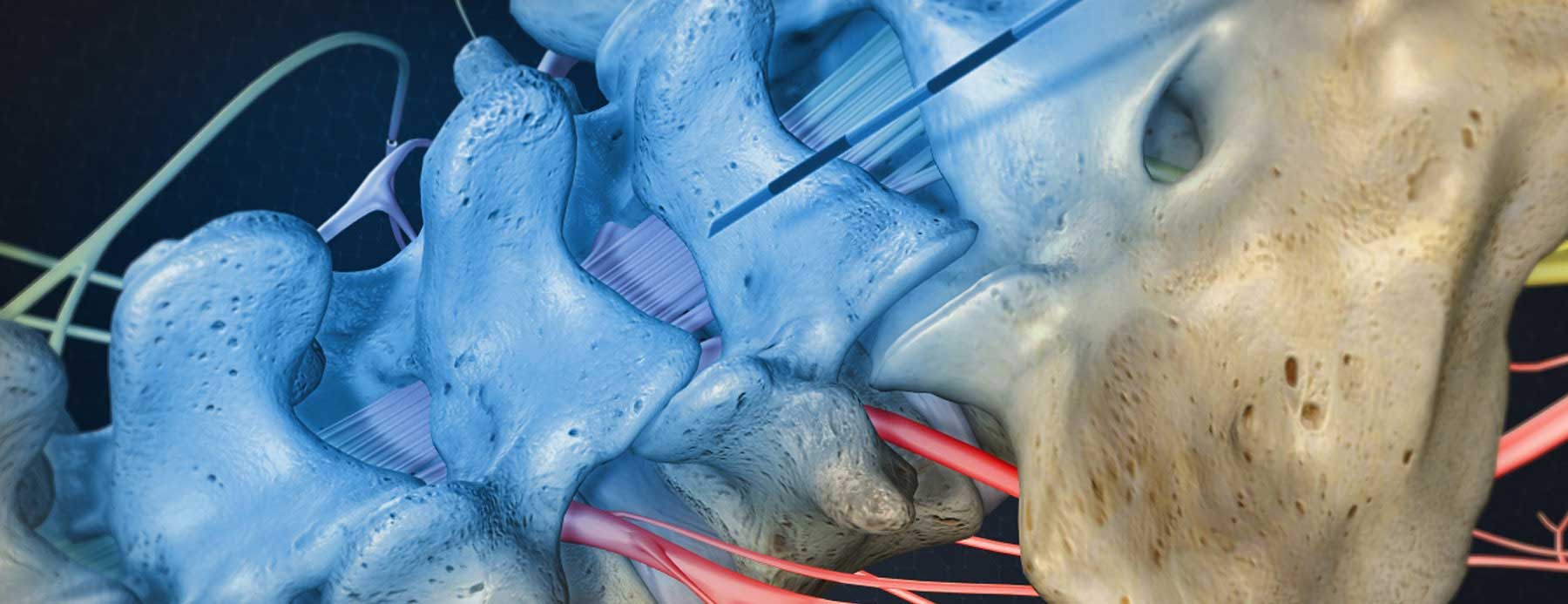 Interventional Spine And Pain Procedures in NYC | New York Pain Care