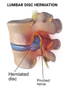 Does Pregnancy Cause Herniated Disc | New York Pain Care