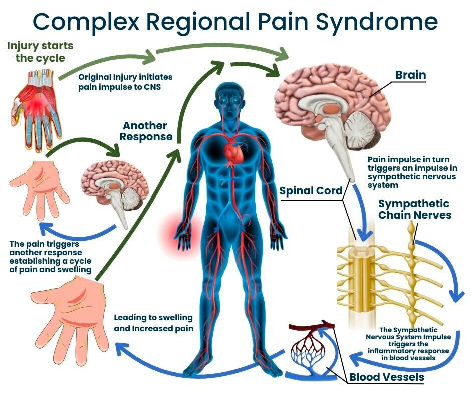CRPS Specialist NYC Complex Regional Pain Syndrome Treatment