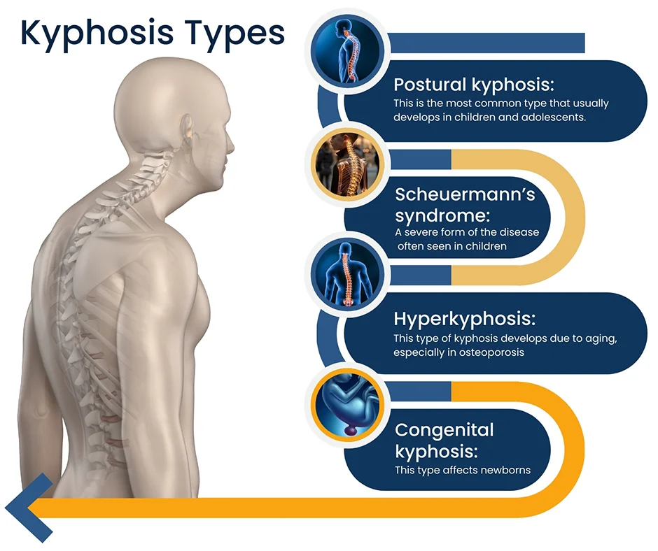 Kyphosis Types Symptoms Causes Diagnosis Pictures