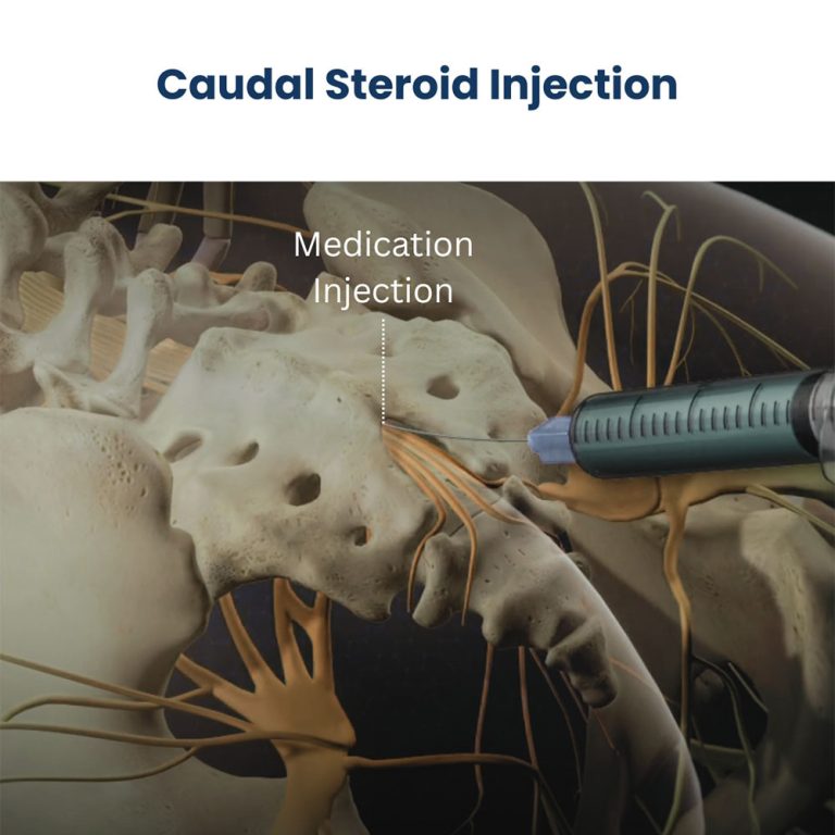 Caudal Epidural Steroid Injection in NYC | New York Pain Care