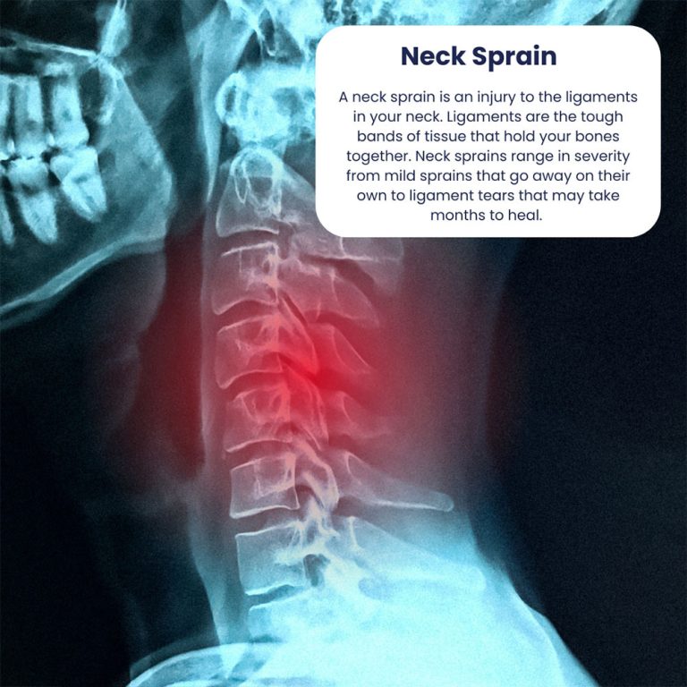 Neck Sprain Doctors in NYC